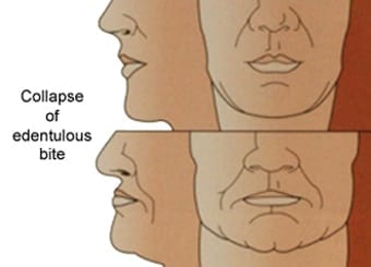 Facial Collapse Naperville IL